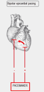 Robotic Pacemaker Lead Placement, Cardiac Resynchronization Therapy